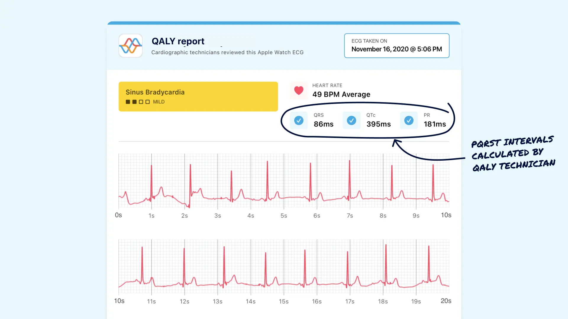 QRS Interval on Your Watch ECG - Narrow, Normal, and Wide | Qaly